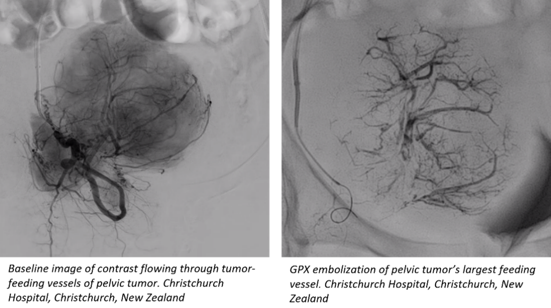 New Liquid Embolic Multi-Center Trial Successfully Enrolls Final Patient