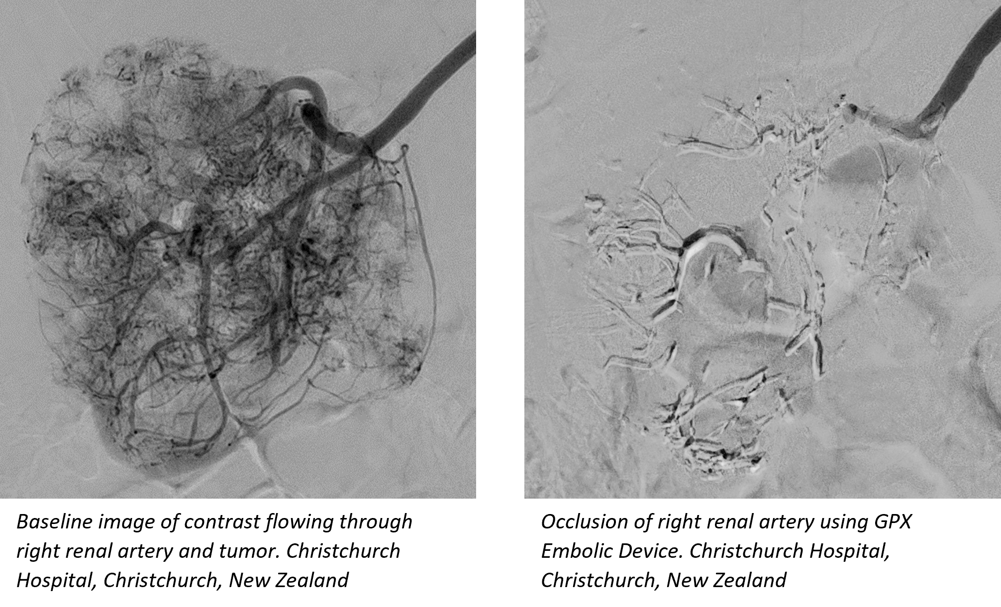 Multi-Center Liquid Embolic Study Concludes